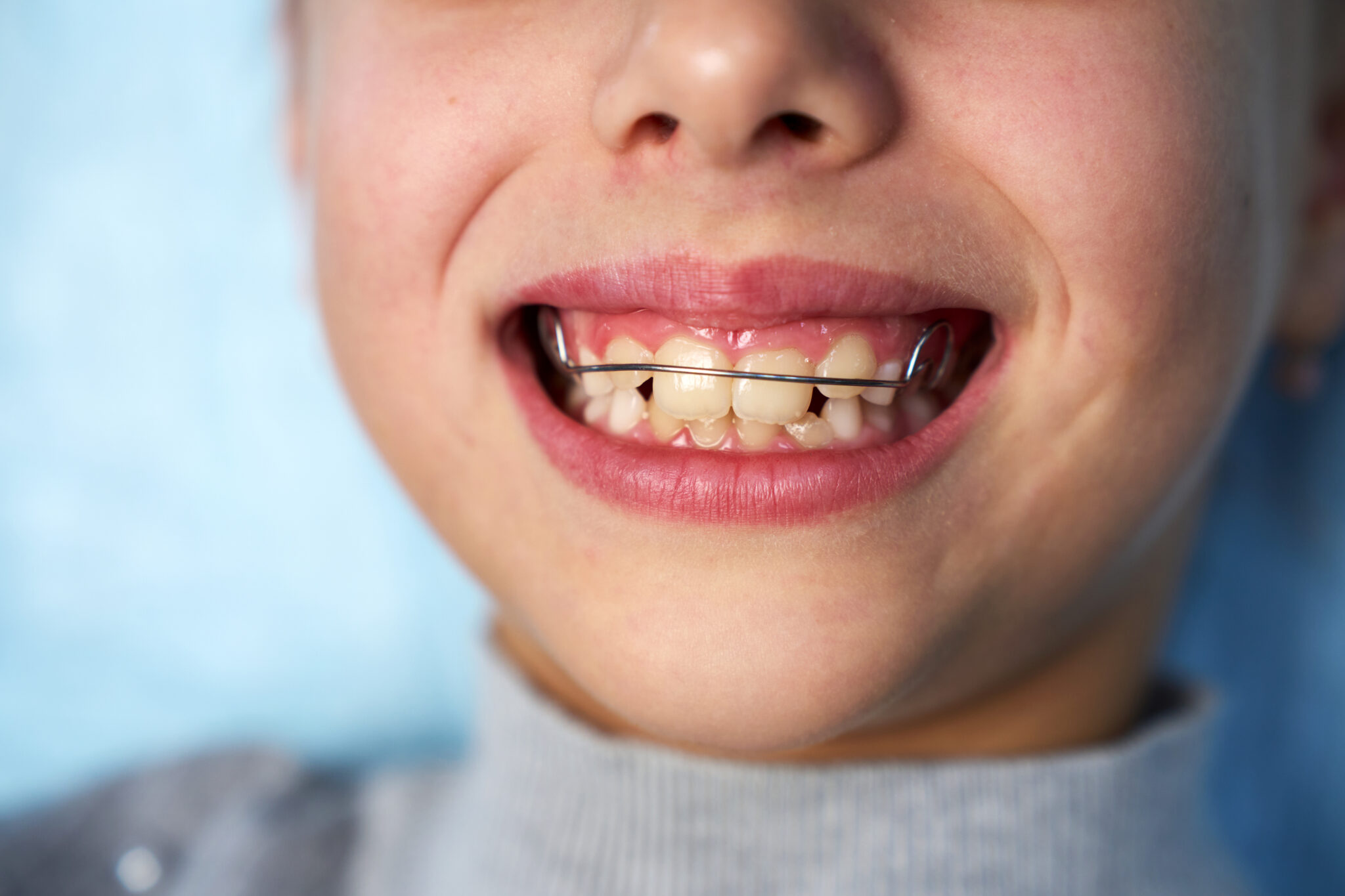 Helping Smiles With Retainers - Riverside Dental Group