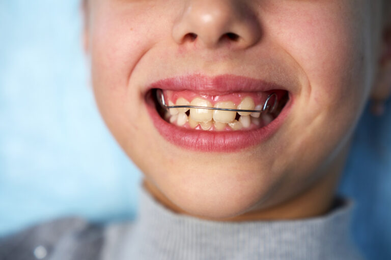 Helping Smiles With Retainers - Riverside Dental Group